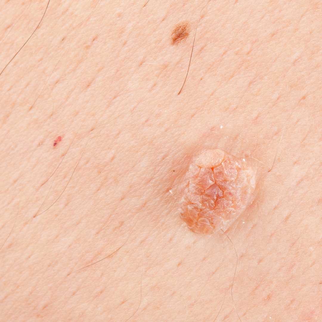 What Causes Warts? | Private Wart Specialists in London
