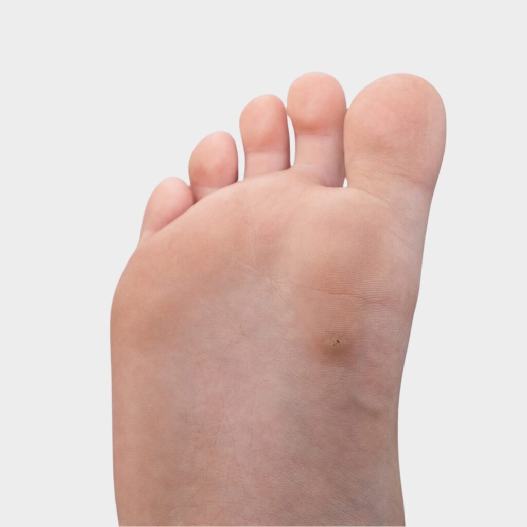 London Verruca (Plantar Wart) Removal