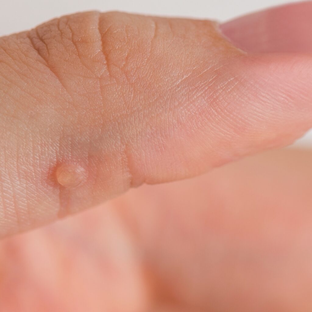 Warts - London Wart Clinic