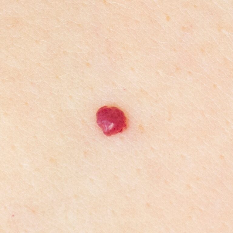 Wart, Cyst, Mole and Skin Tag Removal - London Wart Clinic