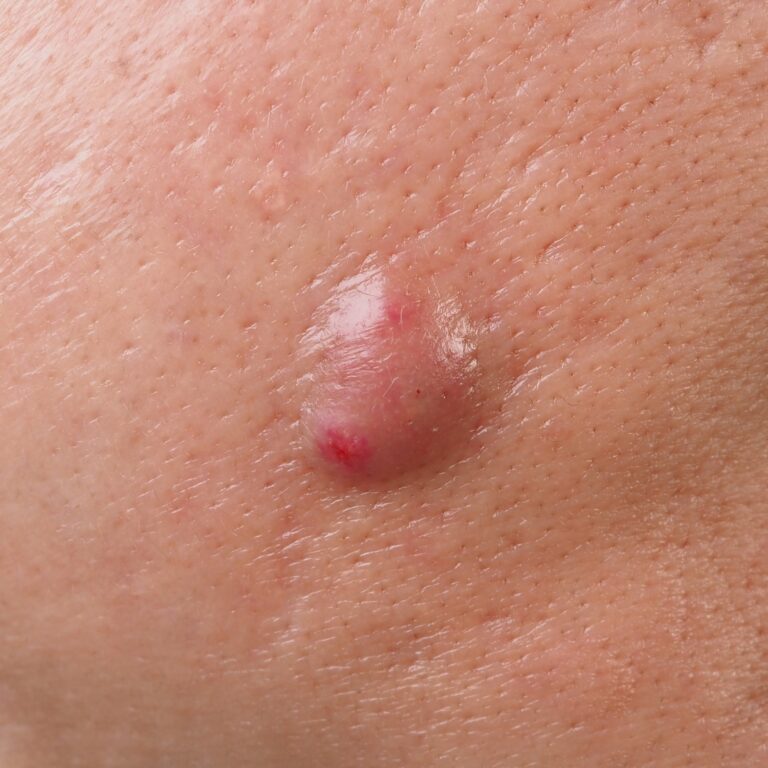 Wart, Cyst, Mole and Skin Tag Removal - London Wart Clinic