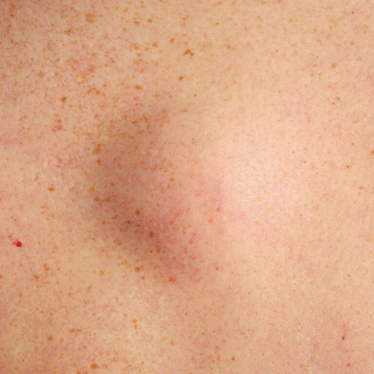 Wart, Cyst, Mole and Skin Tag Removal - London Wart Clinic