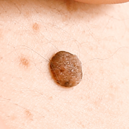 Wart, Cyst, Mole and Skin Tag Removal - London Wart Clinic