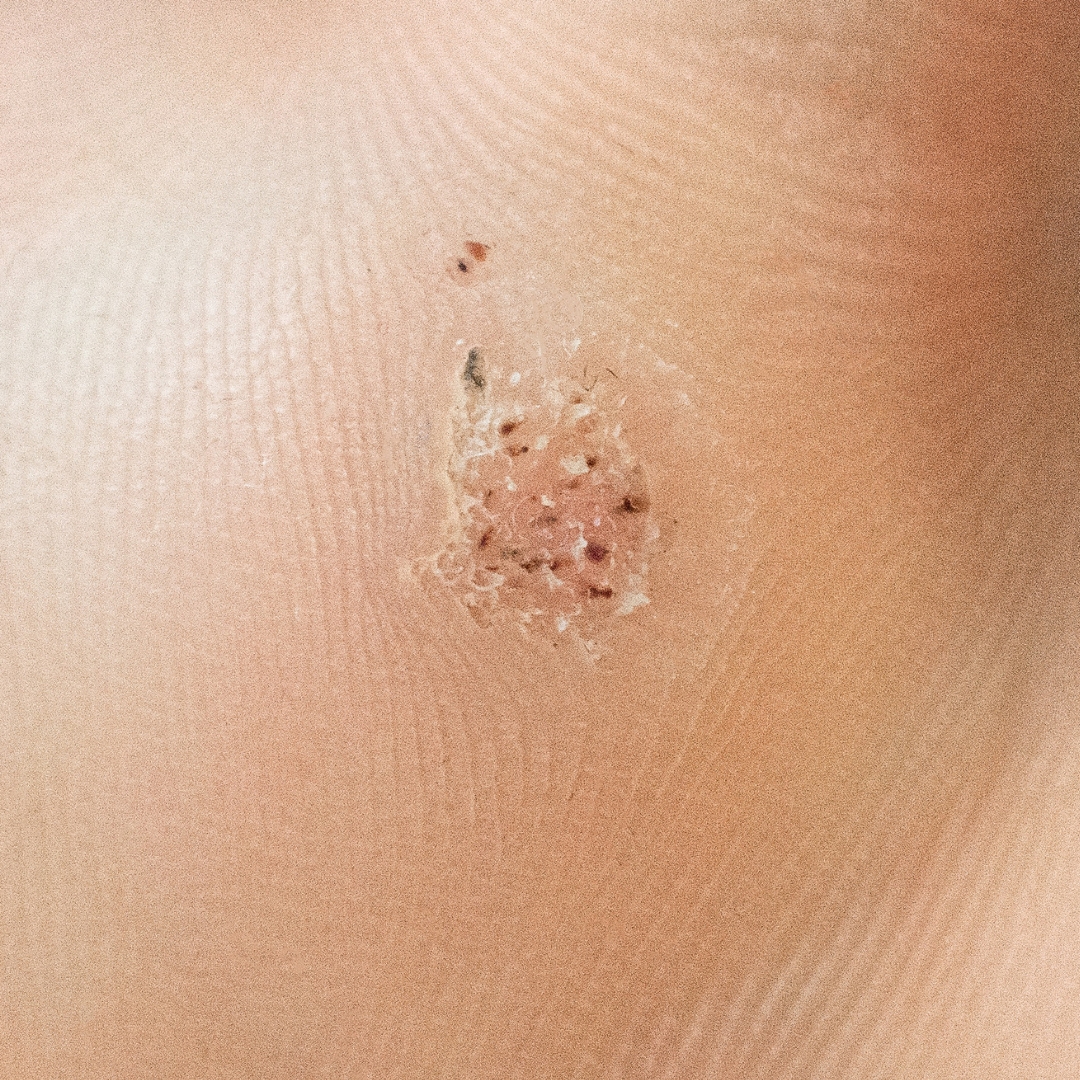 Wart, Cyst, Mole and Skin Tag Removal - London Wart Clinic