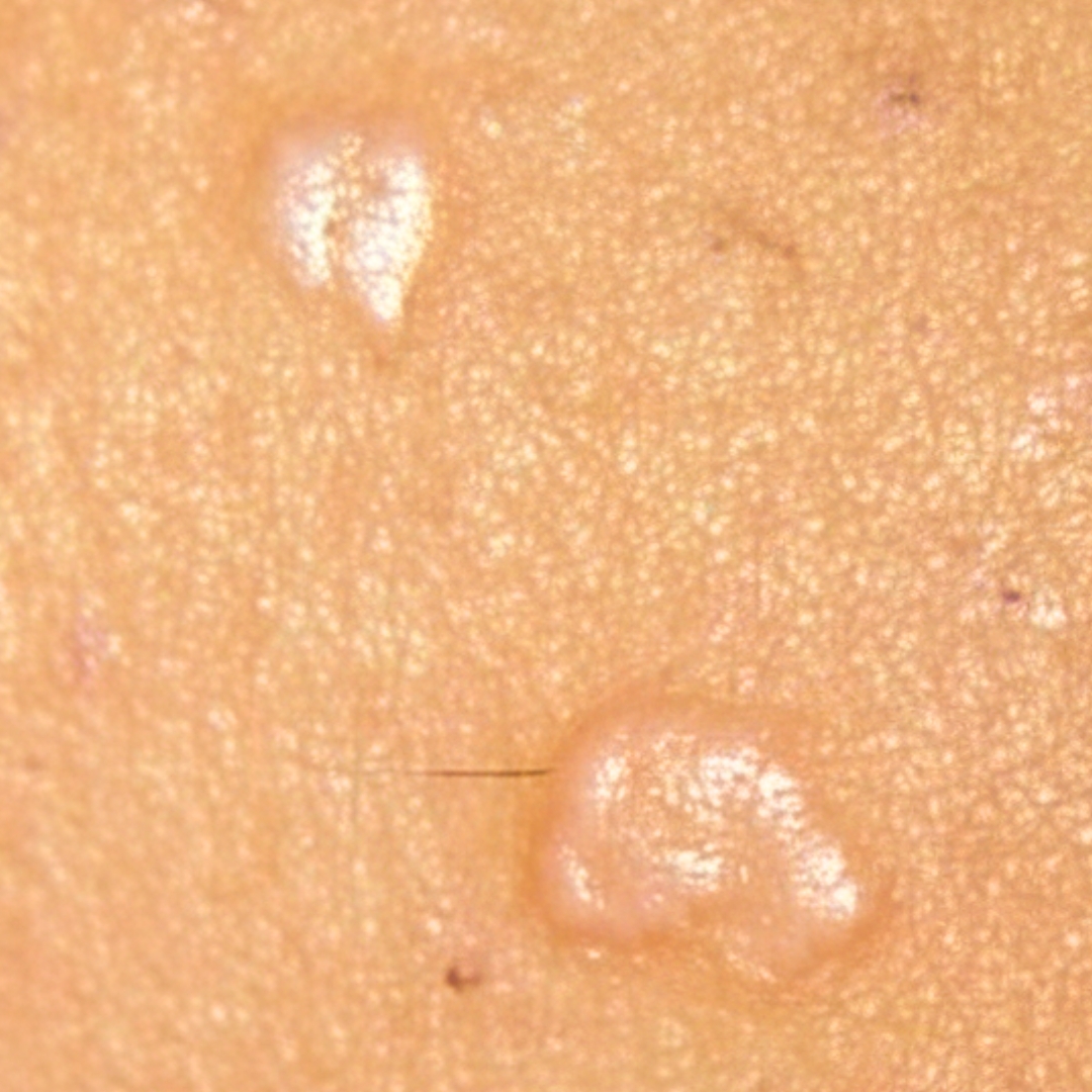 Flat Warts: How to Identify and Treat - London Wart Clinic