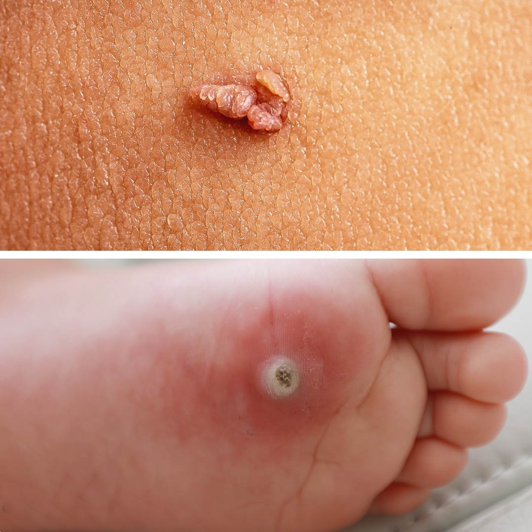Verrucas vs Warts: What’s the Difference?