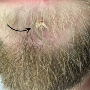 Filiform Warts: Causes and Removal Options