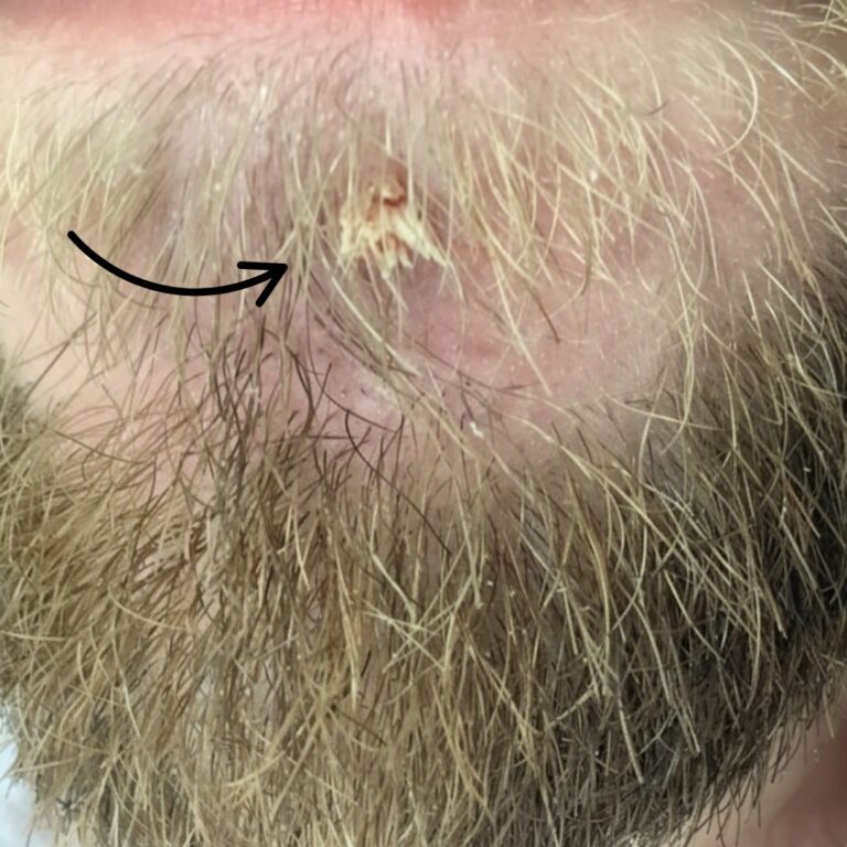 Filiform Warts: Causes and Removal Options